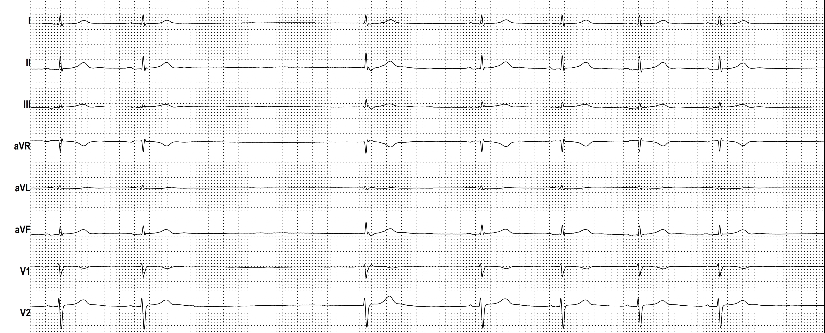 SICK SINUS SYNDROME | ECG Guru - Instructor Resources